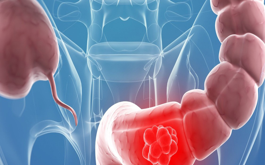 Eliminar el evitar el cáncer de Colon